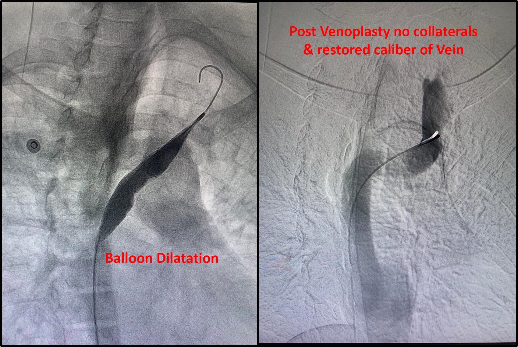 CENTRAL VENOPLASTY - Dr. Vishal Bakare
