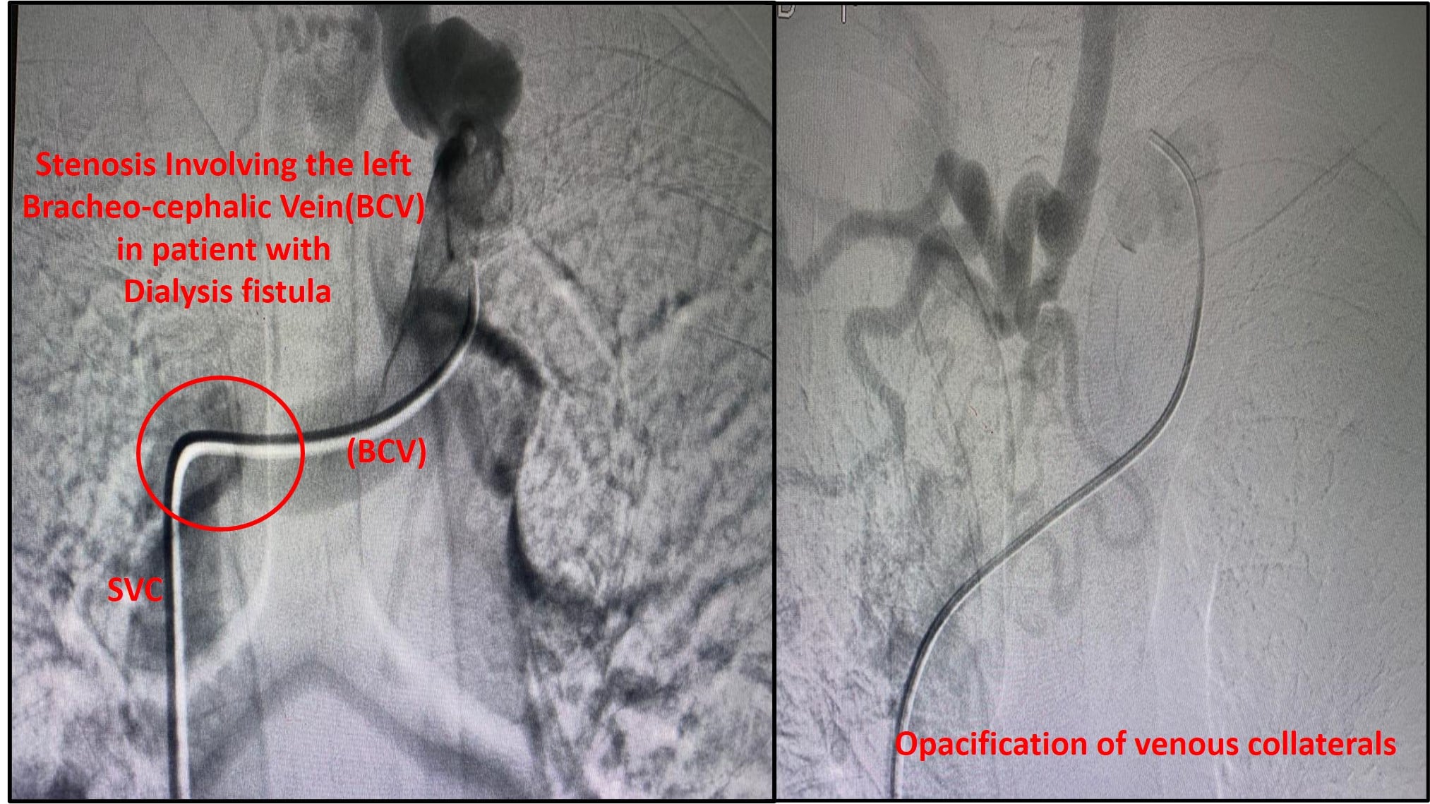 CENTRAL VENOPLASTY - Dr. Vishal Bakare
